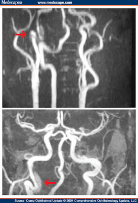 Kathy's MRI Pathology Blog: Neck Vessels / Dissection of the Carotid Artery