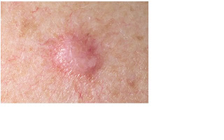 dermatology skin care: Dermatofibroma