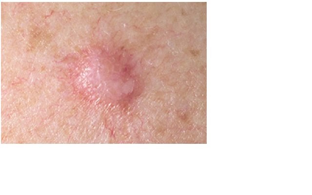 dermatology skin care: Dermatofibroma