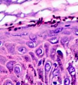 Antisense DNA: Dermatophyte