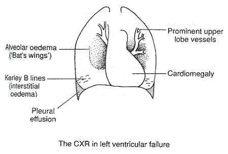 Chest X-Ray in Left Ventricular Failure ~ medik-ukm