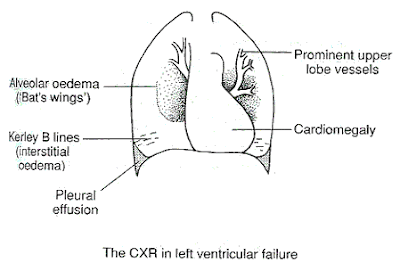 Chest X-Ray in Left Ventricular Failure ~ medik-ukm