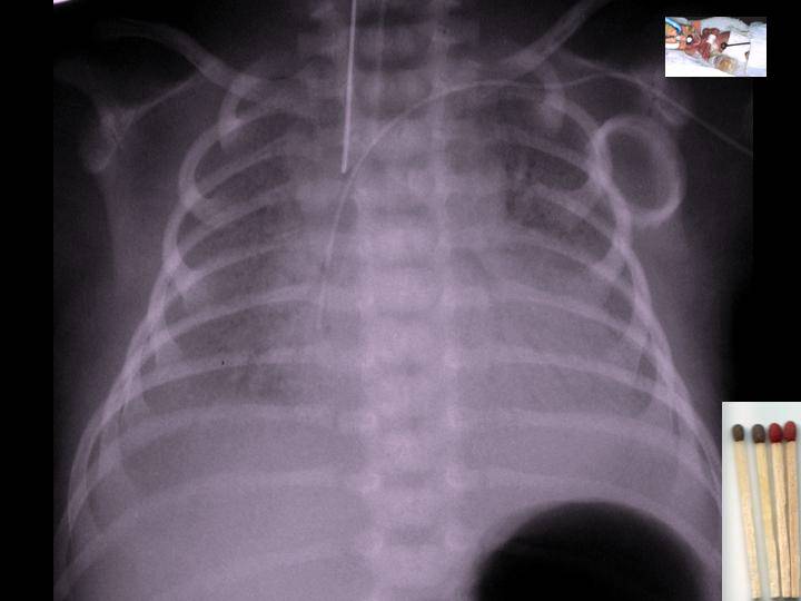 Grading of Respiratory Distress Syndrome ~ medik-ukm