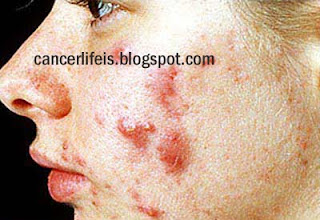 Types of Cancer: Acne