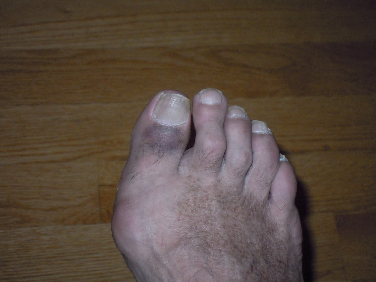 Hammer Toes Causes And Cures - Sharita Little