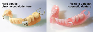 CLINICA DENTAL: Protesis Removible sin Metal . Valplast. Flexiplast