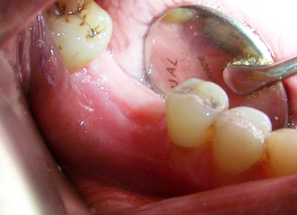 Dr. Gerardo Sagastume: Injerto autólogo sin área dadora