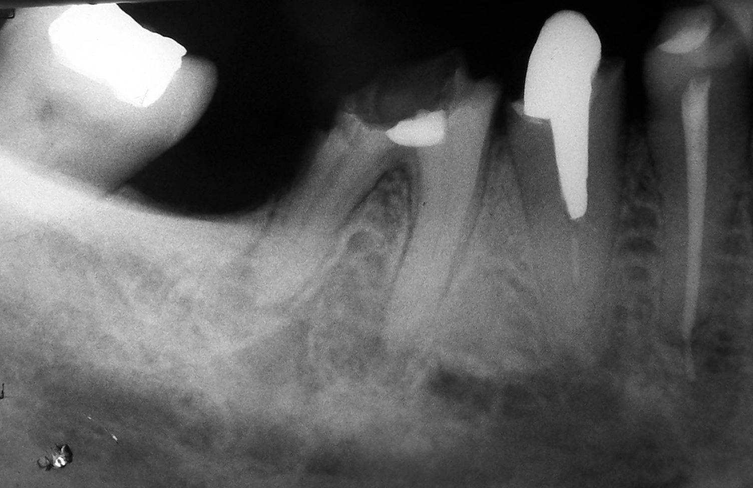 Dr. Gerardo Sagastume: Rehabilitación en zona del 4.6