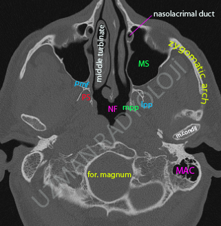 TEMPORAL KEMİK(TEMPORAL BONE) - KAFA TABANI (SKULL BASE) ANATOMİSİ