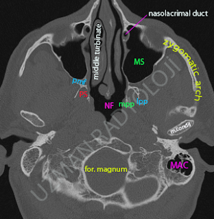 TEMPORAL KEMİK(TEMPORAL BONE) - KAFA TABANI (SKULL BASE) ANATOMİSİ