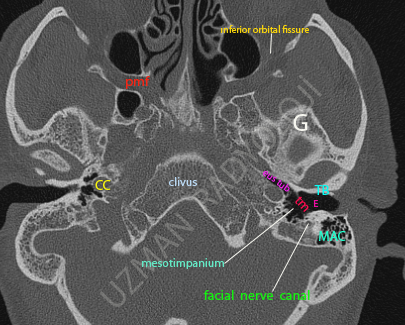 TEMPORAL KEMİK(TEMPORAL BONE) - KAFA TABANI (SKULL BASE) ANATOMİSİ