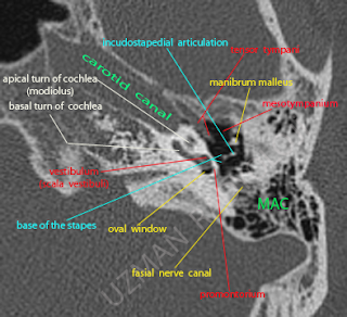 TEMPORAL KEMİK(TEMPORAL BONE) - KAFA TABANI (SKULL BASE) ANATOMİSİ