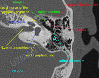 TEMPORAL KEMİK(TEMPORAL BONE) - KAFA TABANI (SKULL BASE) ANATOMİSİ