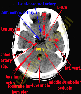 BEYNİN AKSİYEL TOMOGRAFİK ANATOMİSİ (CT OF BRAIN ANATOMI)-II-Hzırlık ...