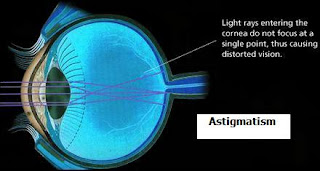 Cataract Operation, Lasik Eye Surgery