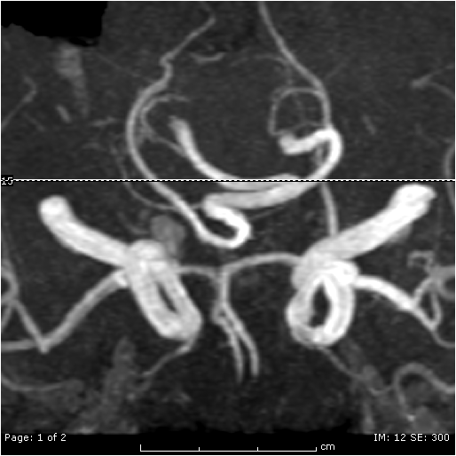 Mindys MRI procedures blog: Aneurysm COW
