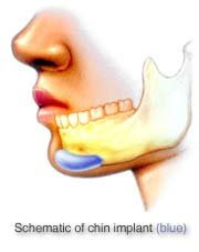 Plastic Surgery for Men: Broad Chin Reduction - Jawline Enhancement ...