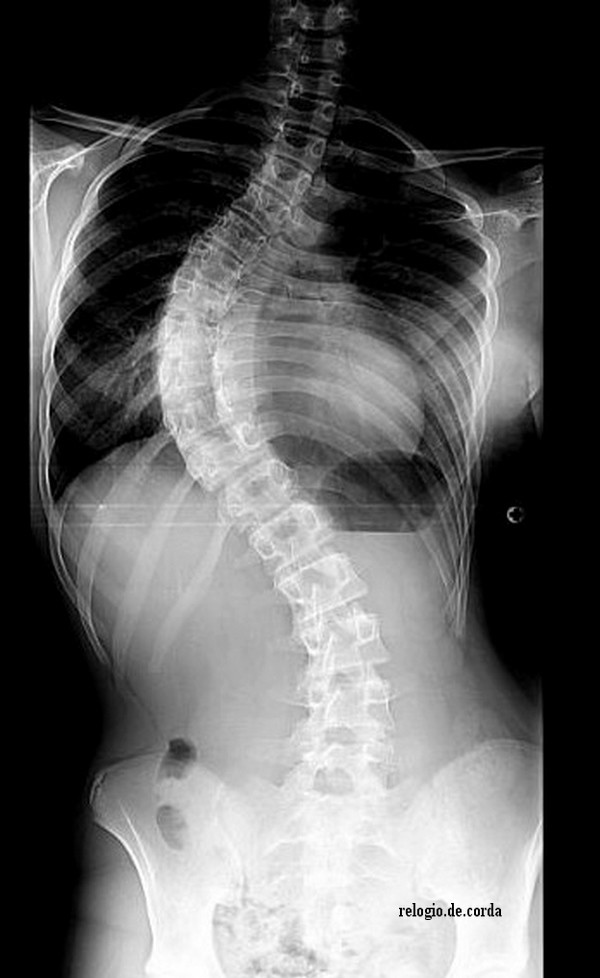 Quanto tempo tem o Tempo?: A escoliose