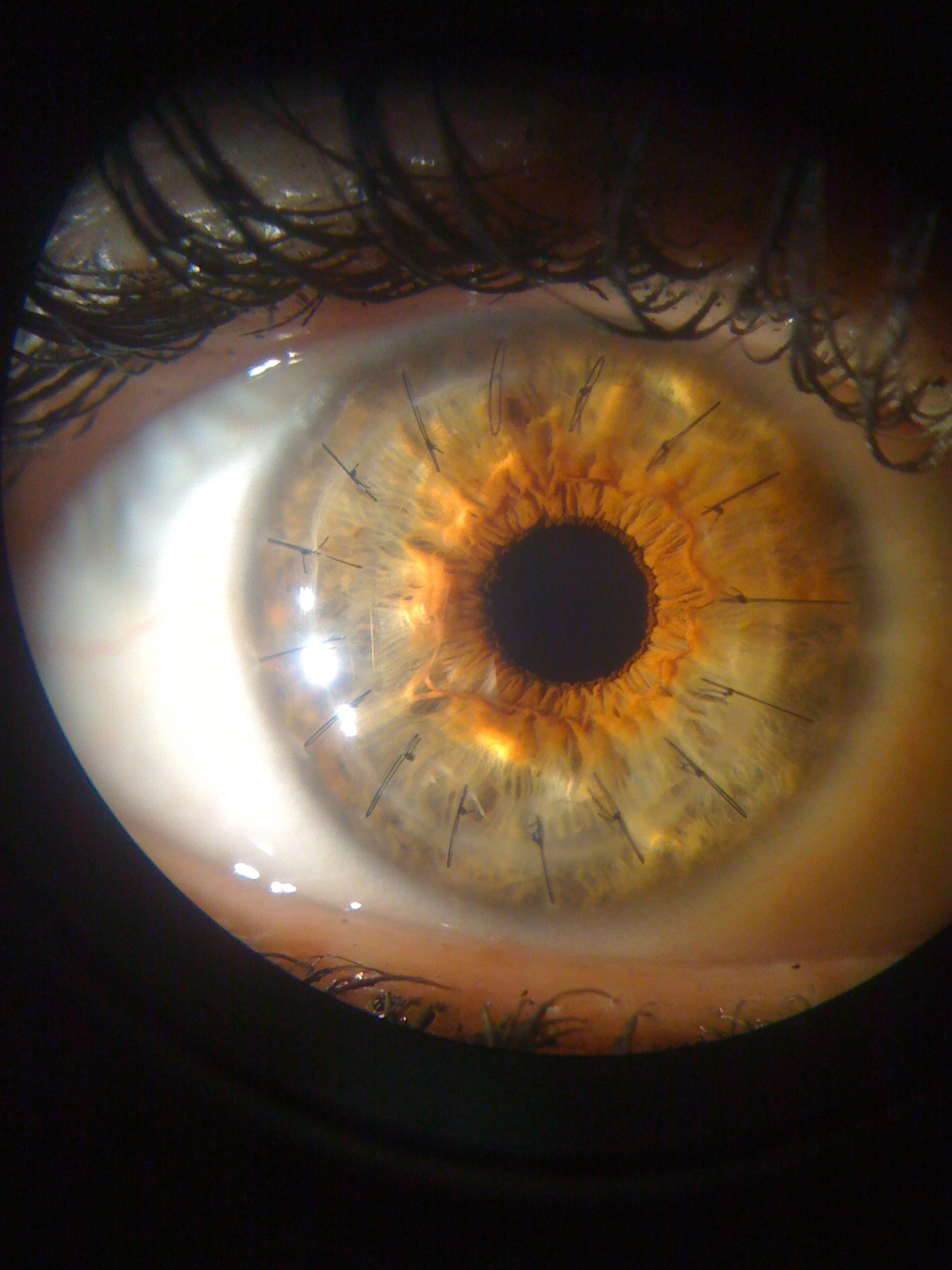 LASIK STUDIOS: Regeneration of the Cornea: Stem cells and the Eye