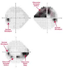 Skyvision Centers: Glaucoma 201: Side Vision Loss