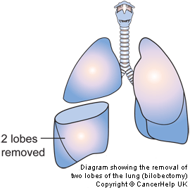 cancer: Cancer Treatment :- Surgery for lung cancer