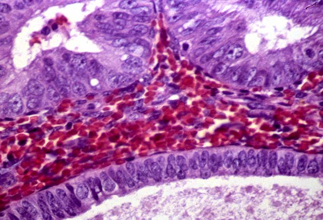patologando na enfermagem: HIPERPLASIA