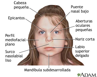 Psiquiatría Infantil y de la Adolescencia: Retraso Mental