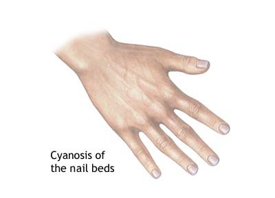 Beriberi disease - Vitamin B1 deficiency | Nutrition, deficiency & diseases