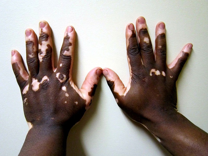 White Discoloration On Skin Pale Skin Discoloration The Dynamic Natural Skin Care