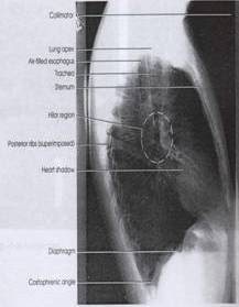 Materi Radiologi: Teknik Radiografi Thorax Lateral