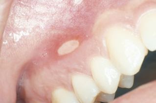 Pediatric Dentistry: Aphthous Ulcers (Canker Sores)