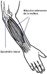 TURBINA: Tratamiento Epi. Epicondilitis