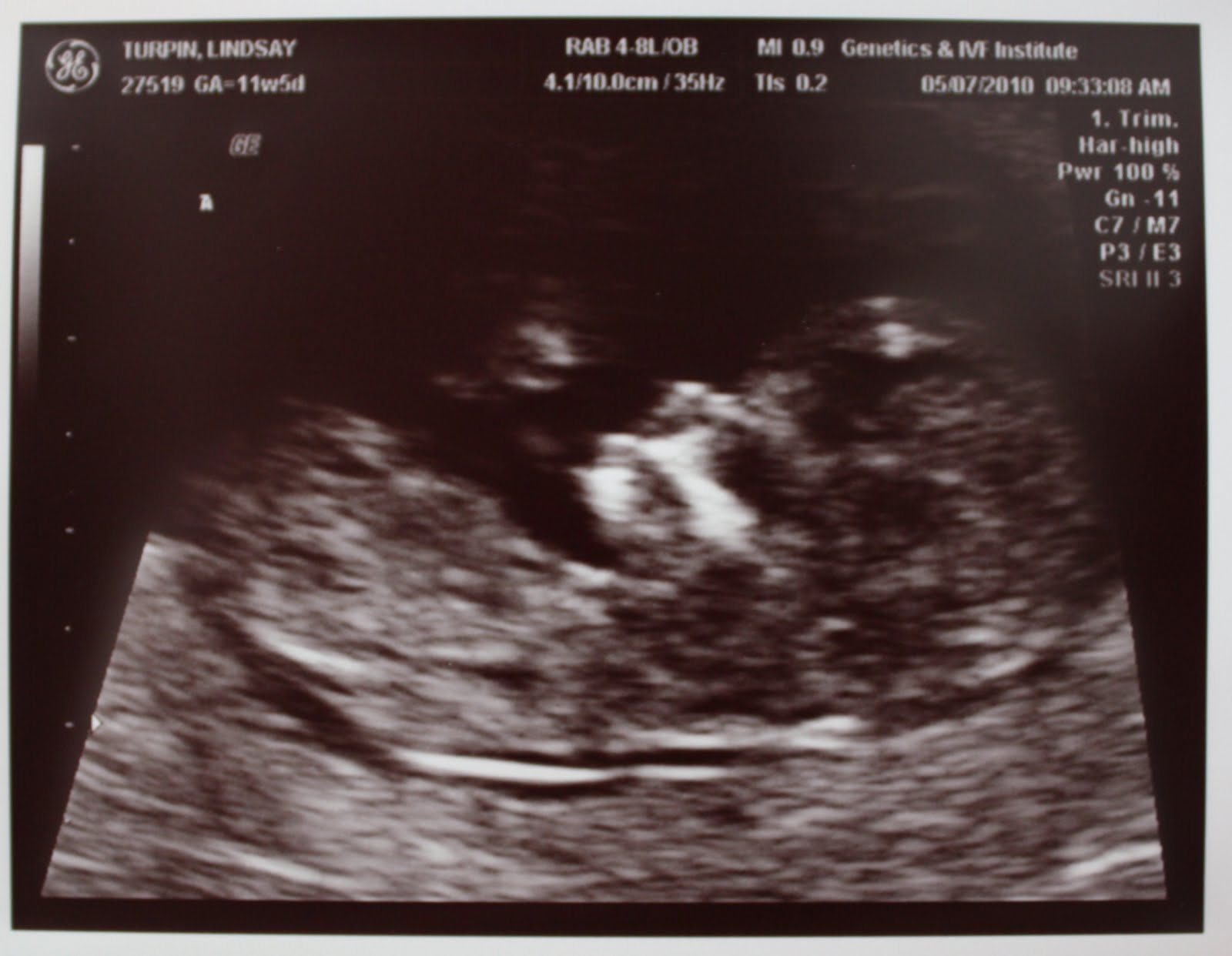 Adventures in Baby Making: 12 weeks ultrasound
