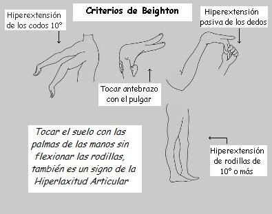 Hiperlaxitud articular Ehlers Danlos: La Hiperlaxitud Articular ¿Qué es?