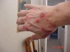 SYNDROME OR BEHCET´S DISEASE: SYNDROME OR BEHCET´S DISEASE