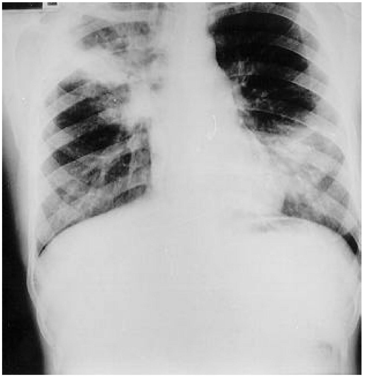 Fisioterapia PUC-Minas: IMAGEM EM TUBERCULOSE PULMONAR