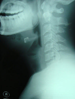 Emergency Medicine Blog: Ludwig's Angina