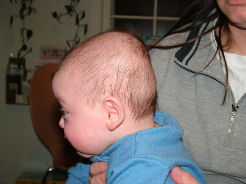 Physio Questions: Are you worried about your child's headshape or ...