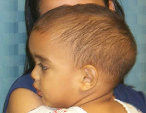 Physio Questions: Are you worried about your child's headshape or ...