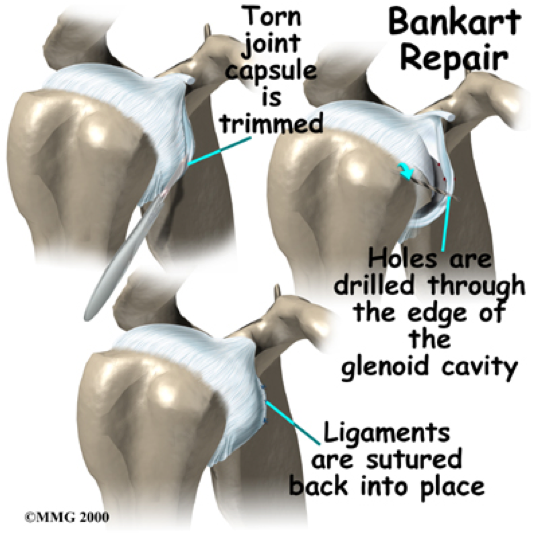 Physio Questions: Shoulder Complex (Part III) - Anterior/Posterior ...