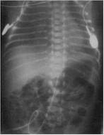 SiMaRoNeT: ENFERMEDAD DE LA MEMBRANA HIALINA