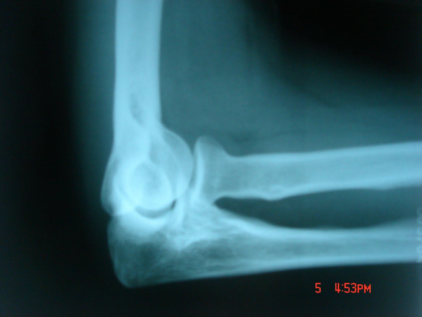 ---RAYOS X 2010--- =): CODO - PROYECCIÓN LATERAL(LATEROMEDIAL)