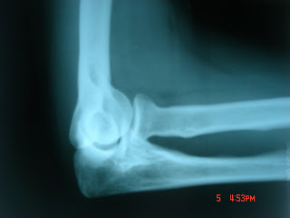 ---RAYOS X 2010--- =): CODO - PROYECCIÓN LATERAL(LATEROMEDIAL)