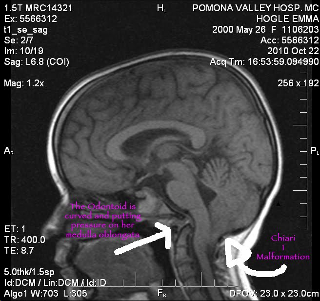 Little Miss Emma Kate: Brain MRI