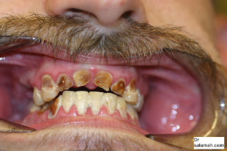 Meth Mouth. by Dr Mohammed Salamah