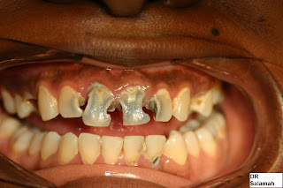 Meth Mouth. by Dr Mohammed Salamah