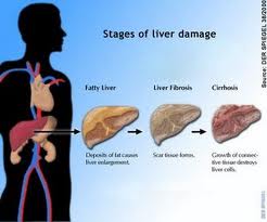 Sirosis Hepatis ~ ridwan nurse