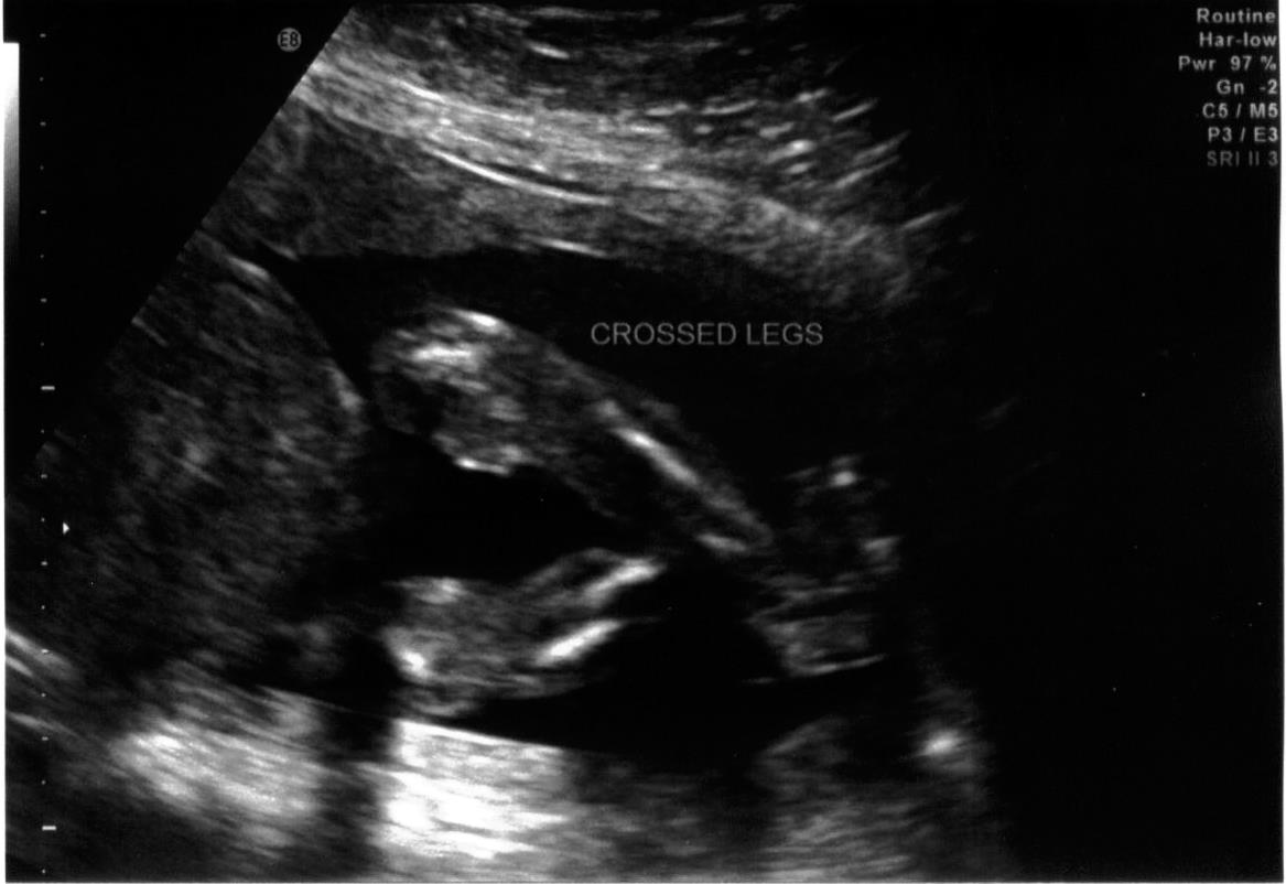 Bert and Kate plus 8: Alien Baby Pictures