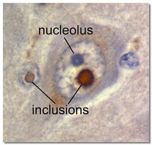 Neurology Minutiae: Diagnostic criteria for FXTAS (fragile x associated ...