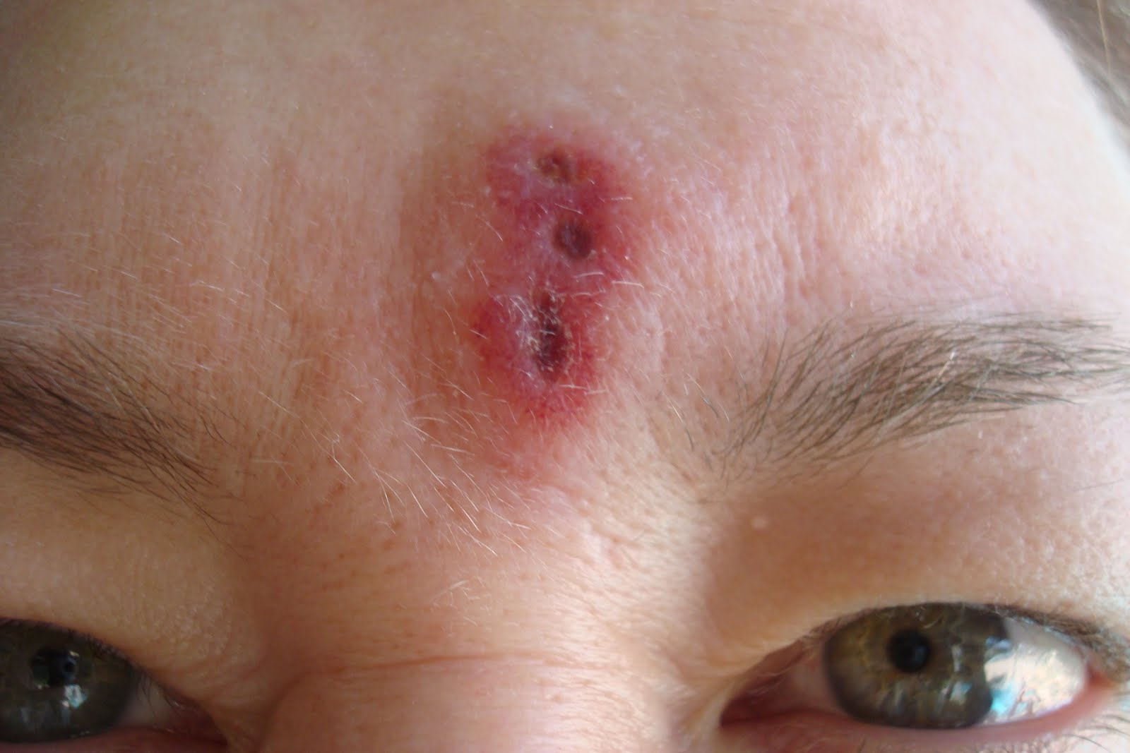 Spider Bite On Forehead